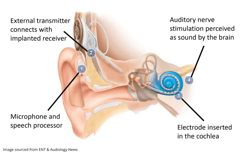 How Cochlear Implants Can Provide Tinnitus Relief