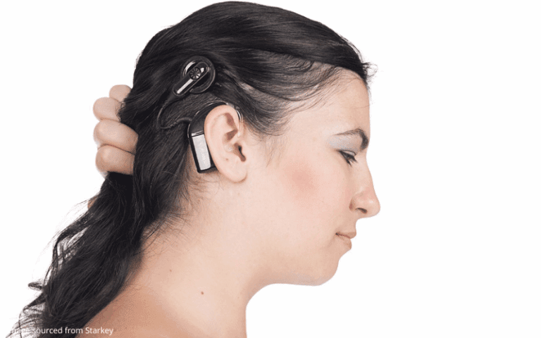 How Cochlear Implants Can Provide Tinnitus Relief